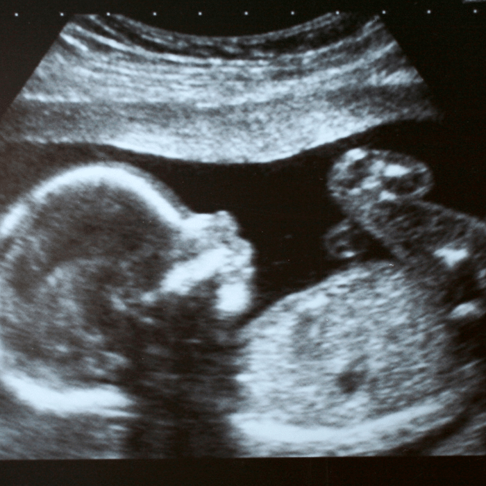 Bitest e translucenza nucale: gli screening fetali del primo trimestre ...