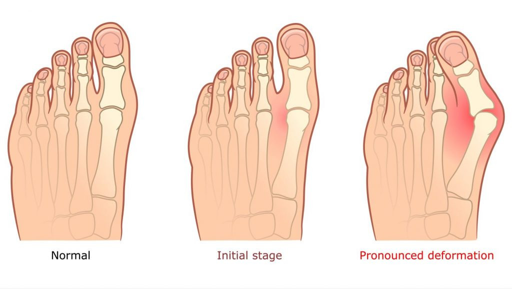 Bunions: Understanding Causes, Recognizing Symptoms, and Exploring ...