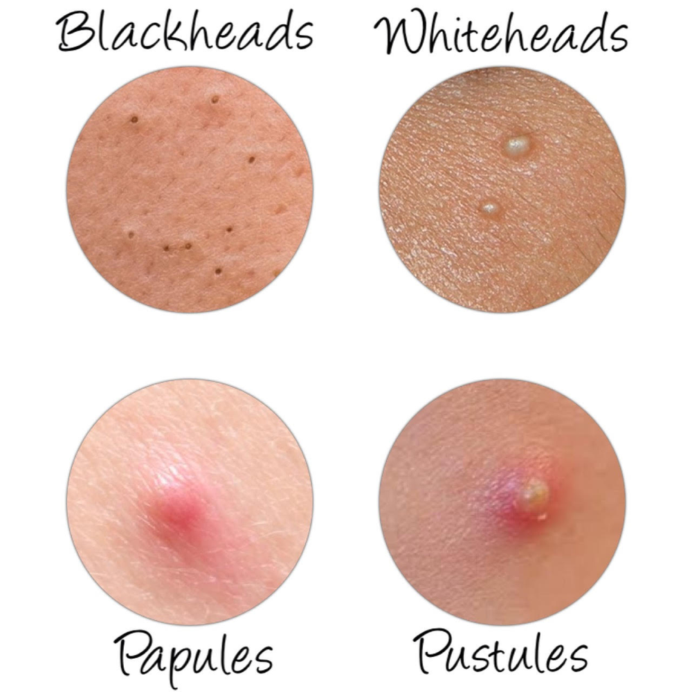 Acne: Know Your Opponent