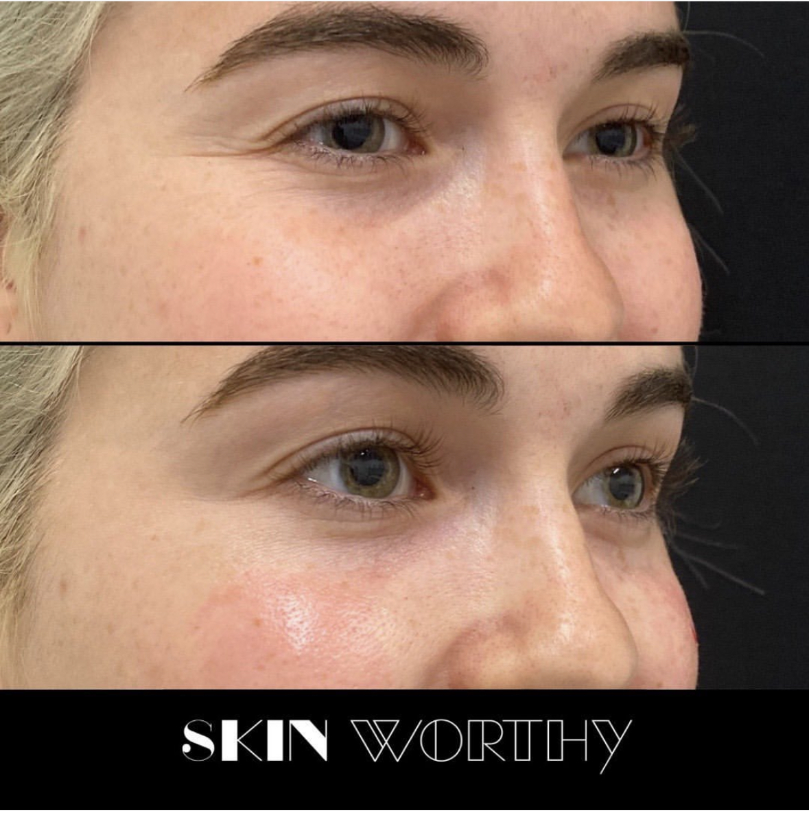 Love at First Sight: Caring for Sensitive Facial Skin