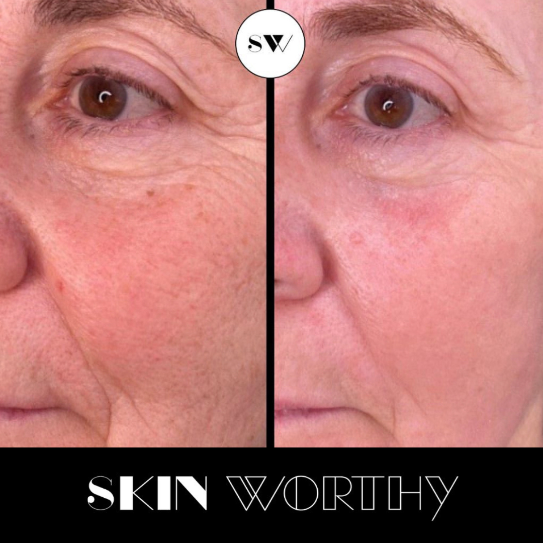 Love at First Sight: Caring for Sensitive Facial Skin