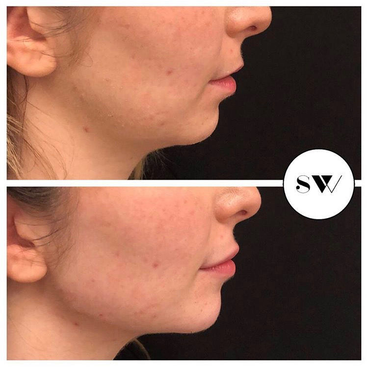 Snatched Jawlines: The Newest Beauty Trend