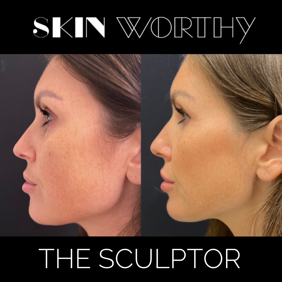Get Better Results with Morpheus8 and Sculptra