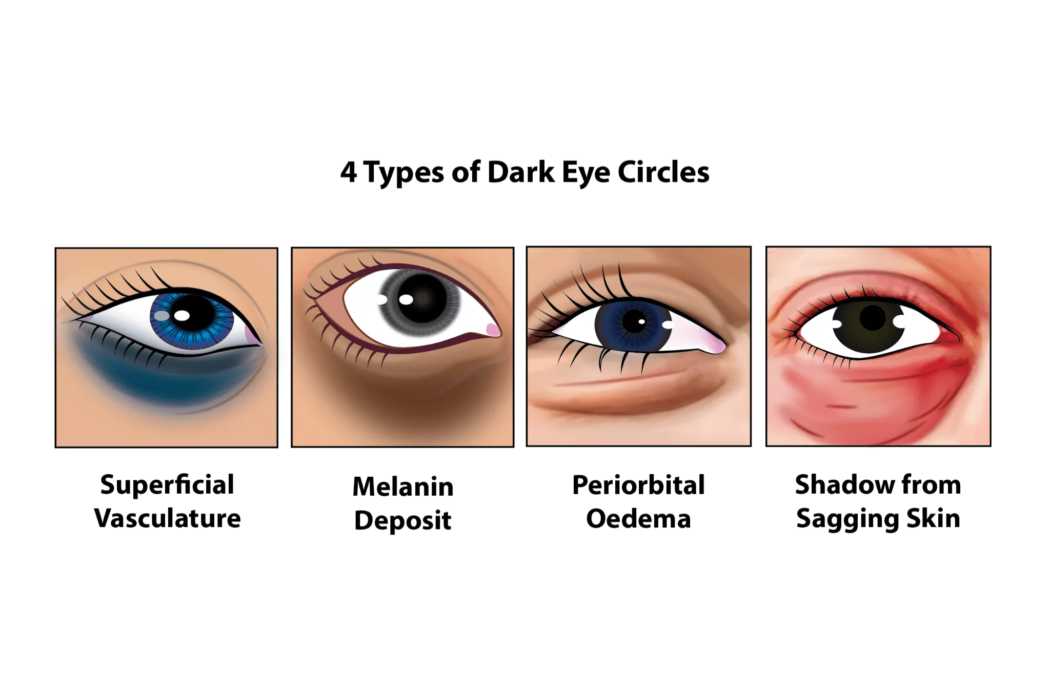 Dark Circles & Tear Troughs: Rejuvenate Your Under-Eye Area