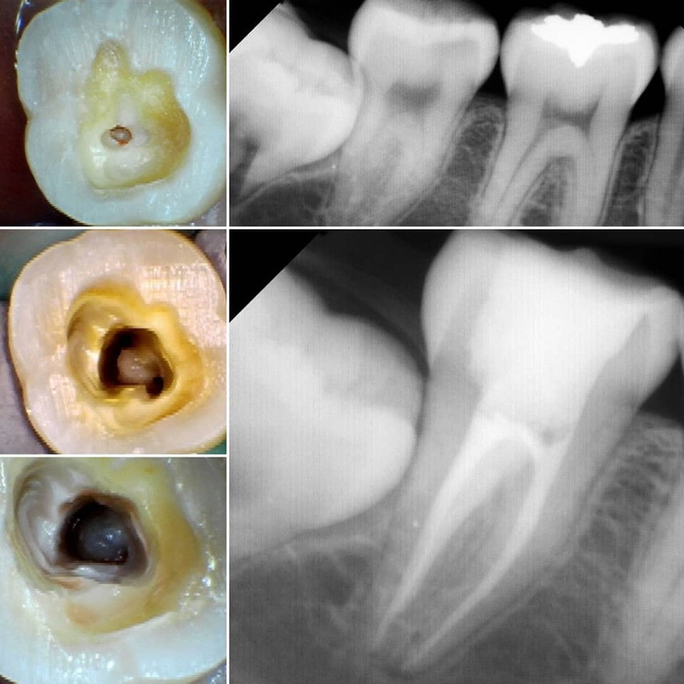 RCT On Tooth 31 RCT On Tooth 31