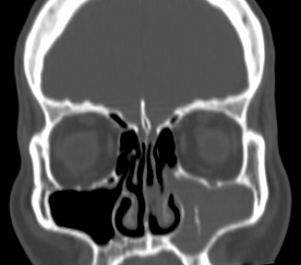 Sinusitis - Otorrinolaringología Costa Rica