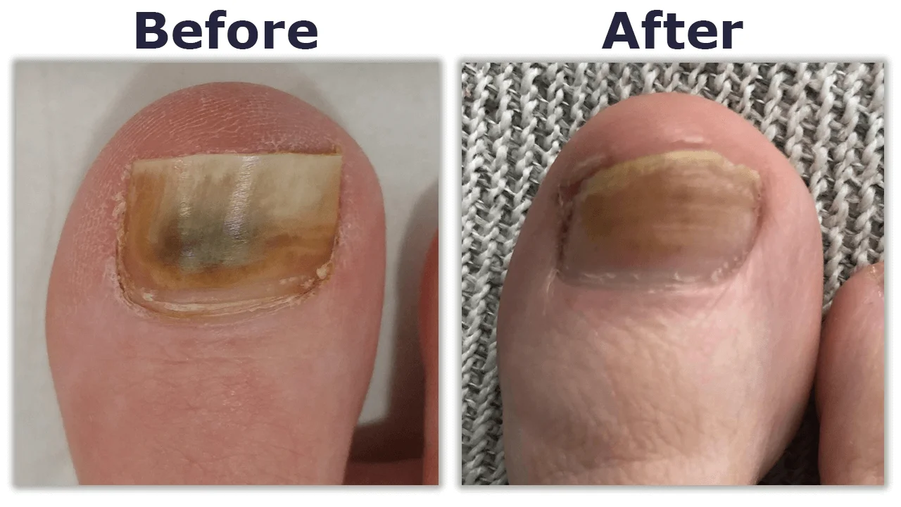 Nail Surgery London | Nail Surgery Treatment | Harley Street Clinic