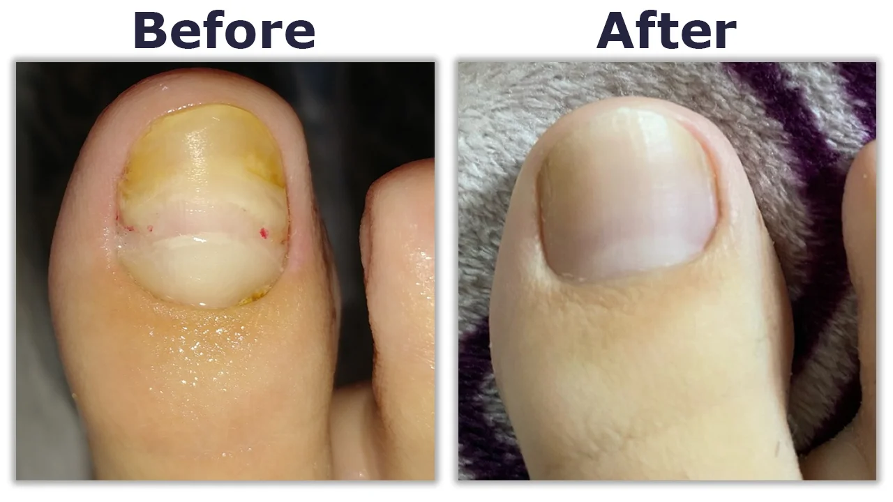 Nail Surgery London | Nail Surgery Treatment | Harley Street Clinic