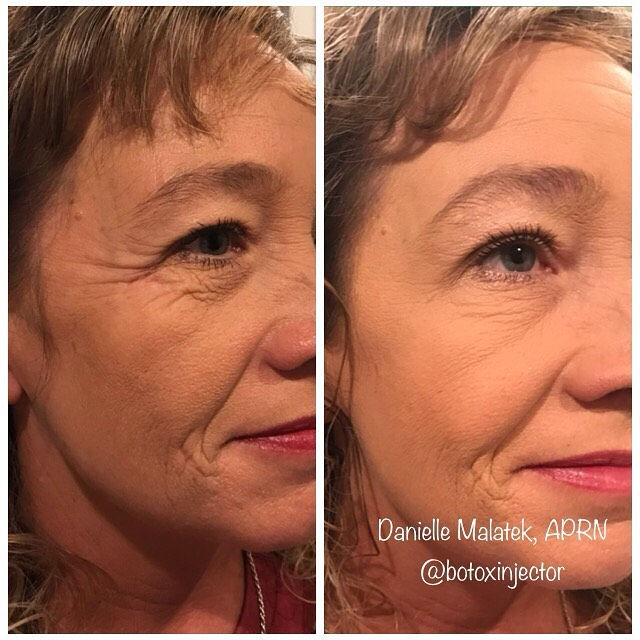 Did you know you can exfoliate too much?