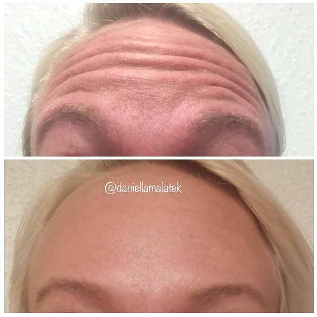 The Botox Side Effects