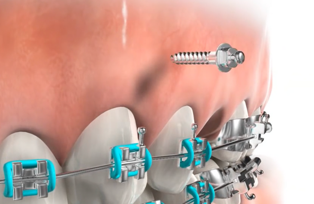 ทำไมต้องใช้หมุดจัดฟัน (miniscrew)