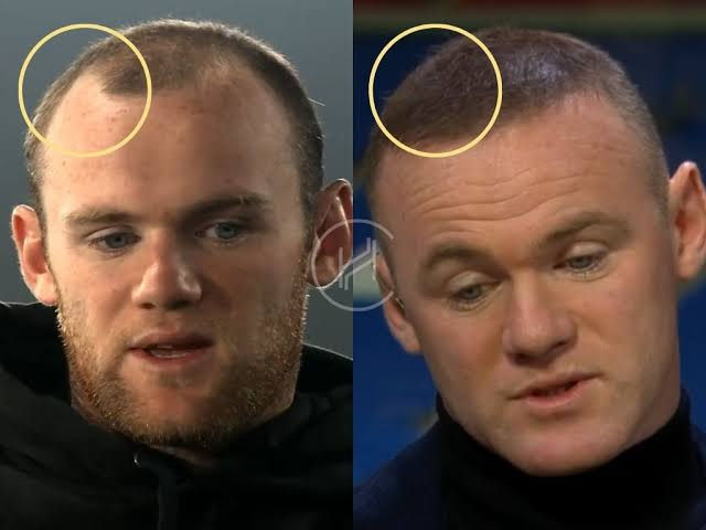 Celebrities and Hair Transplants Celebrities and Hair Transplants