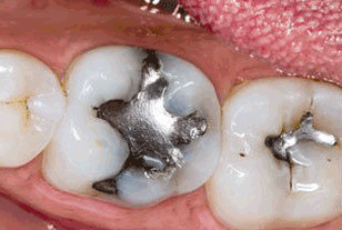 Crown & Bridge Restorations | Crown Dental lab | Innodental lab | Melbourne