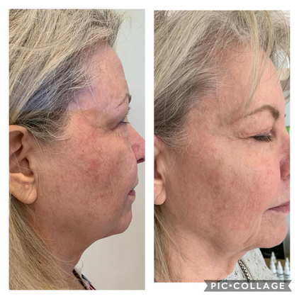 DMK Non-Surgical Treatments | Akoya Face + Body