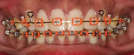 How to Choose the Perfect Braces Color For You - A Complete Guide