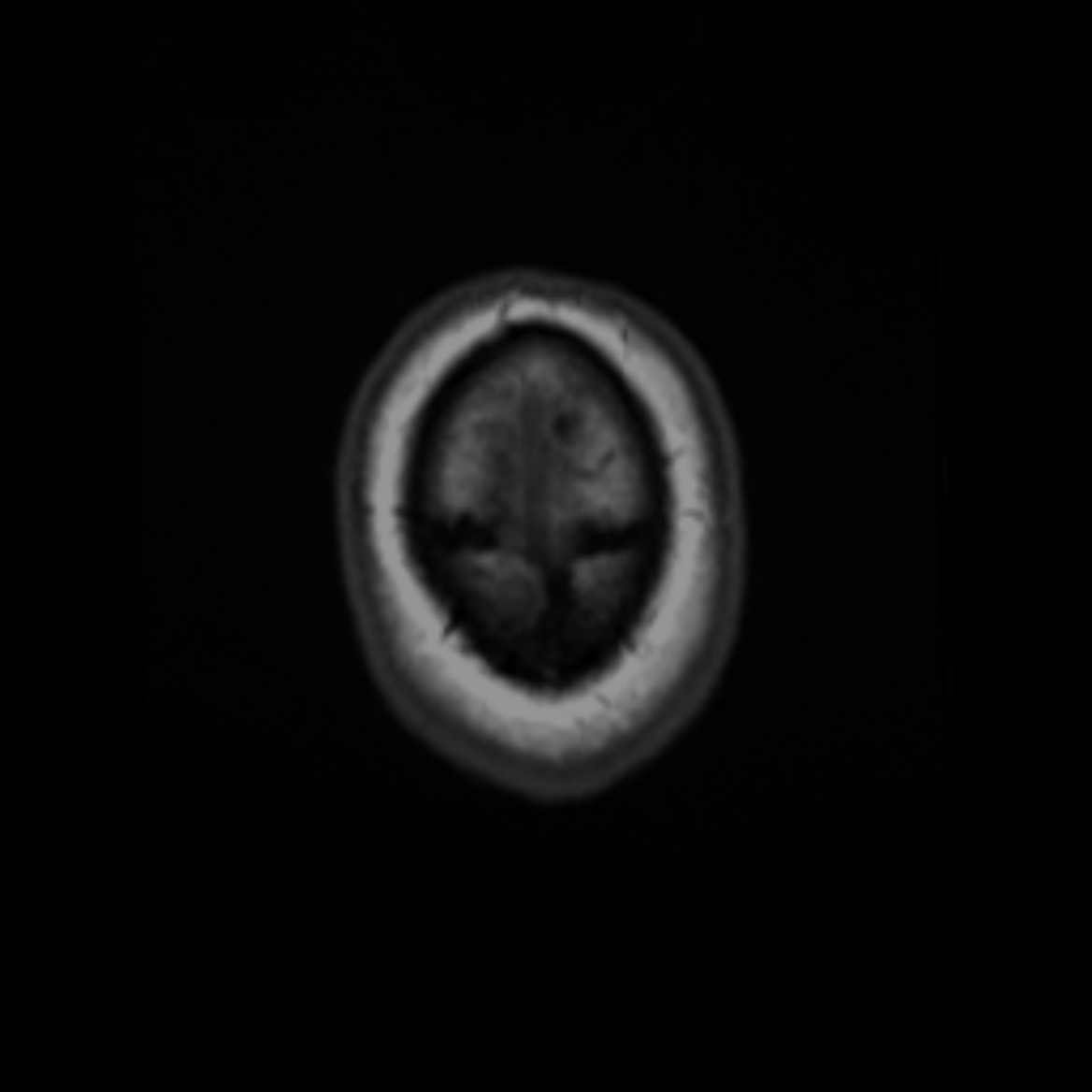 Traumatic Brain Injury | Shin-Imaging