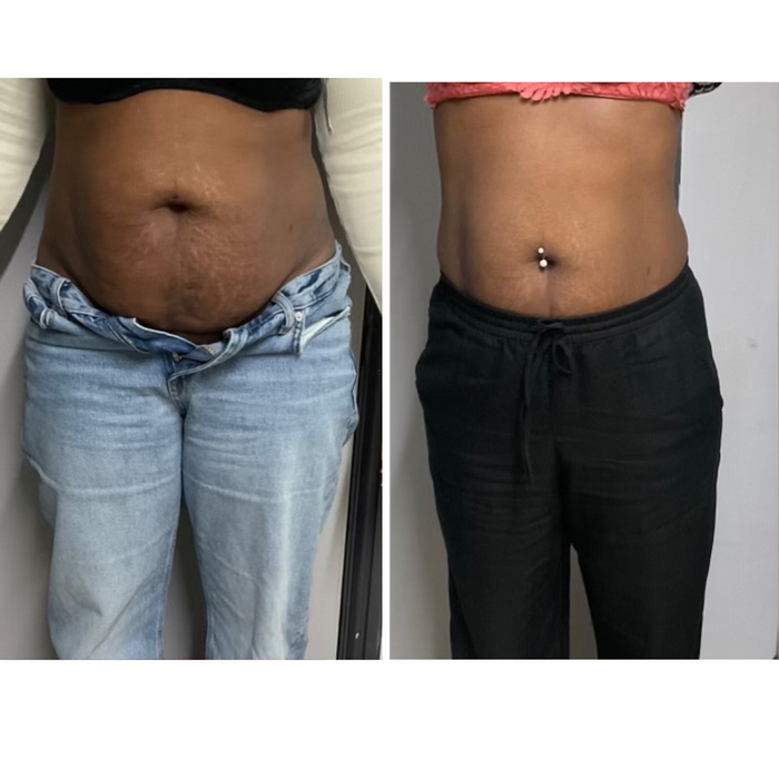 Ultimate Fat Loss | Body Sculpting UK Ultimate Fat Loss | Body Sculpting UK