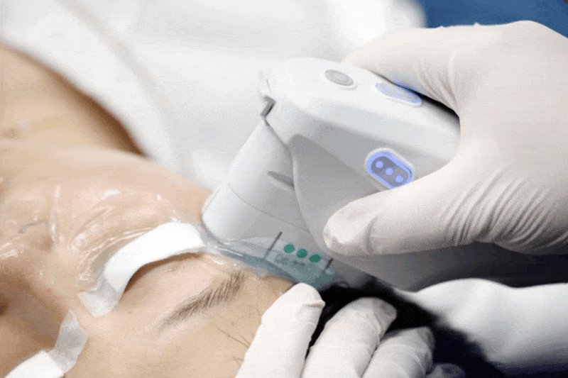 How much does Ultherapy cost in Korea for foreigners in 2025?