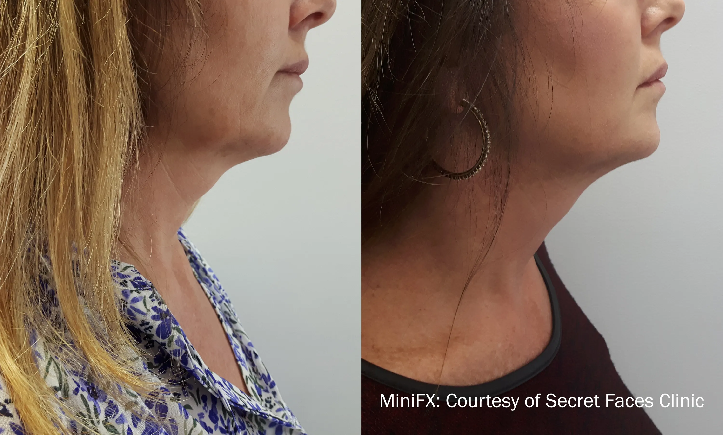 InMode RF | Elegance Cosmetic Skin Clinic | Injectables | Skin & Body ...