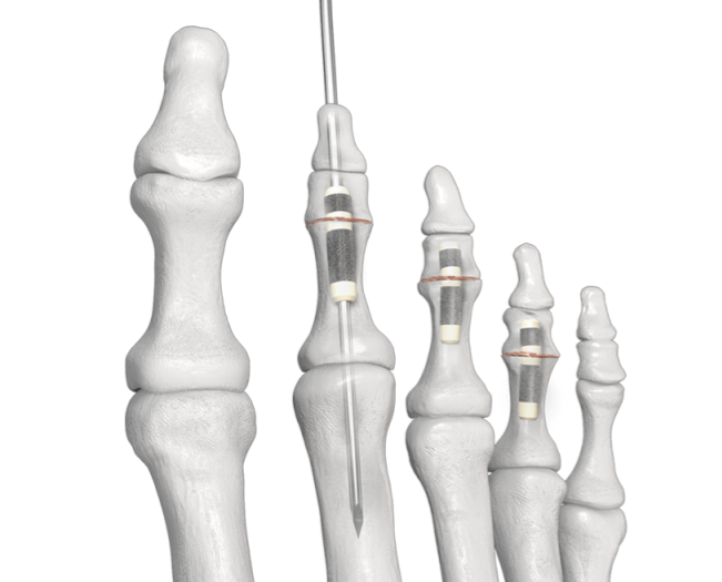 The Hammertube™ Hammertoe Implant