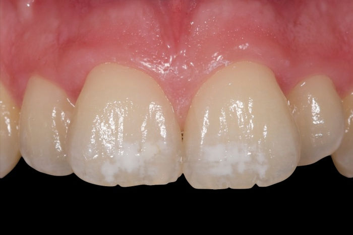 Patologías en la dentición permanente