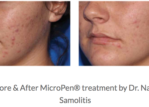 Eclipse Micropen Elite | LE HEALING CLINC