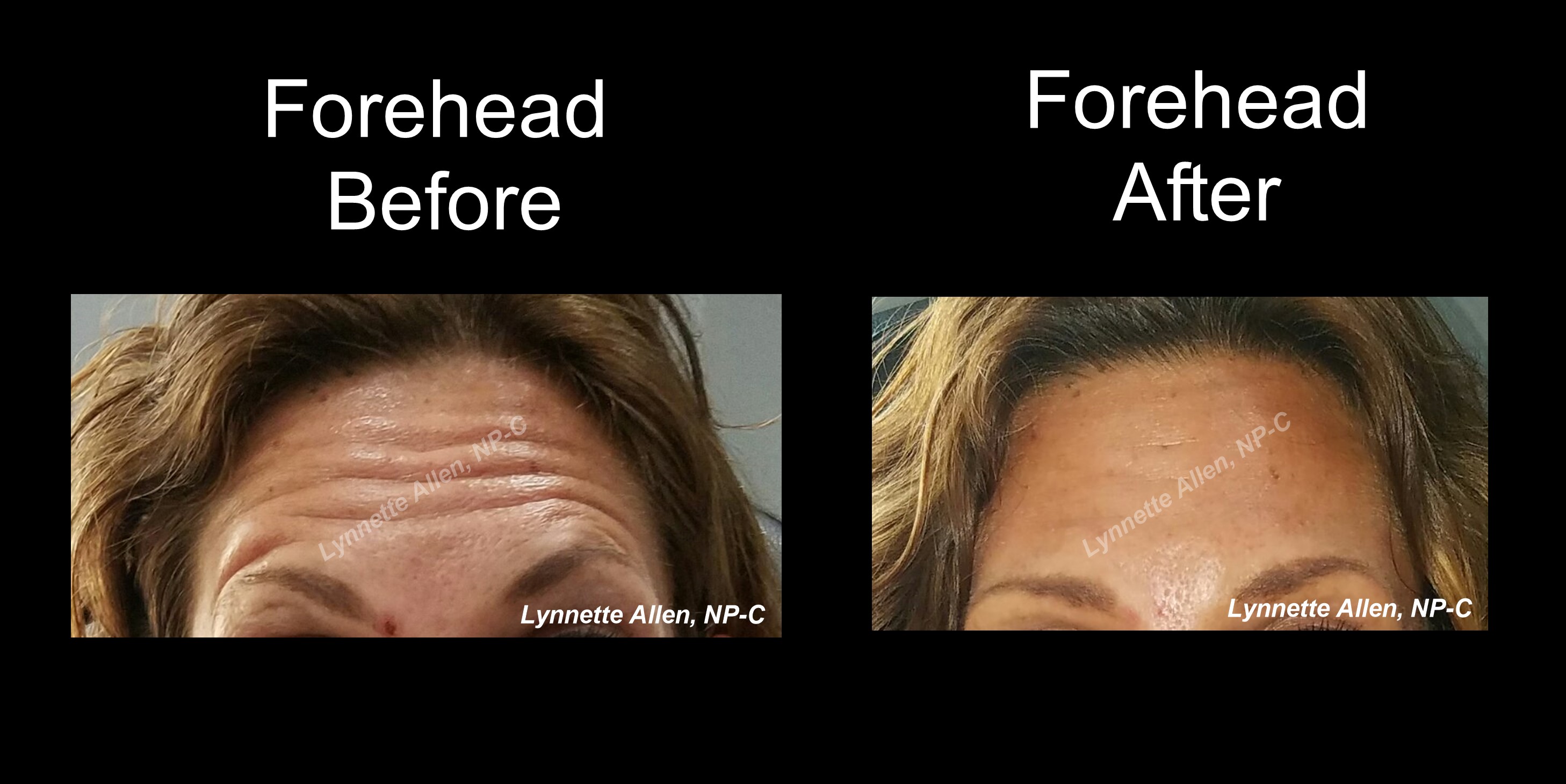 Faces Refreshed | Before & Afters | Botox, Fillers, PDO Threads