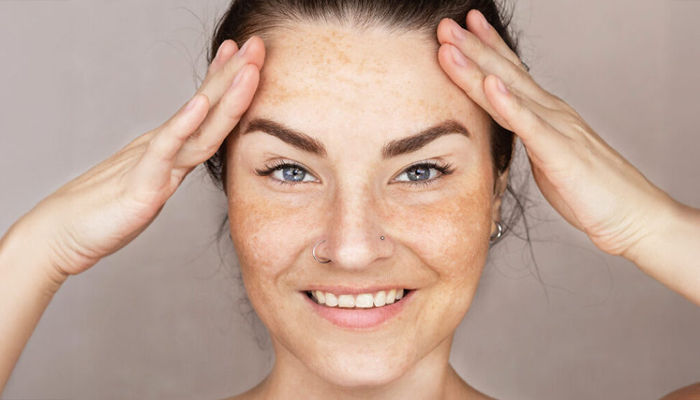 Are Freckles and Blemishes a Common Concern Across All Skin Types?