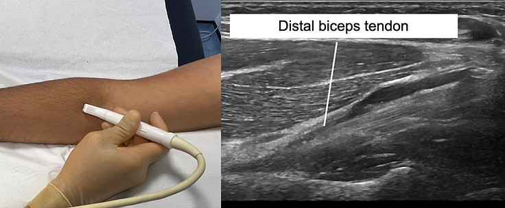 Distal biceps tendon pain | Musculoskeletal Ultrasound & Injections