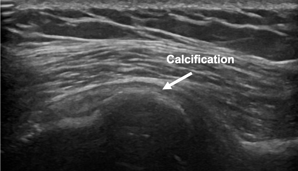 How is shoulder barbotage/lavage "treating calcific tendonitis" done?