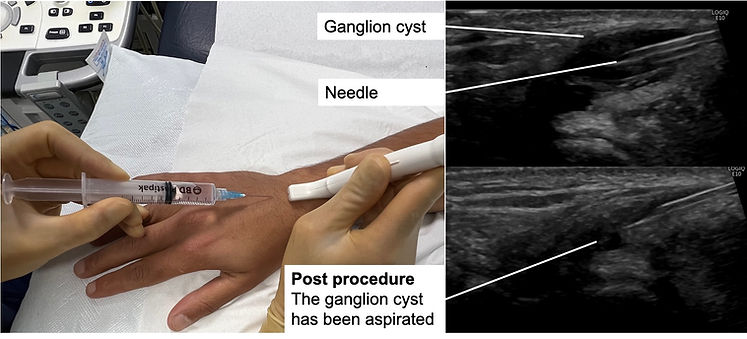 Ganglion cyst aspiration & steroid injection| Musculoskeletal ...