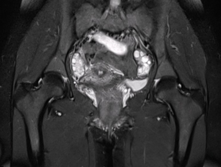 Reasons to get a hip MRI scan!