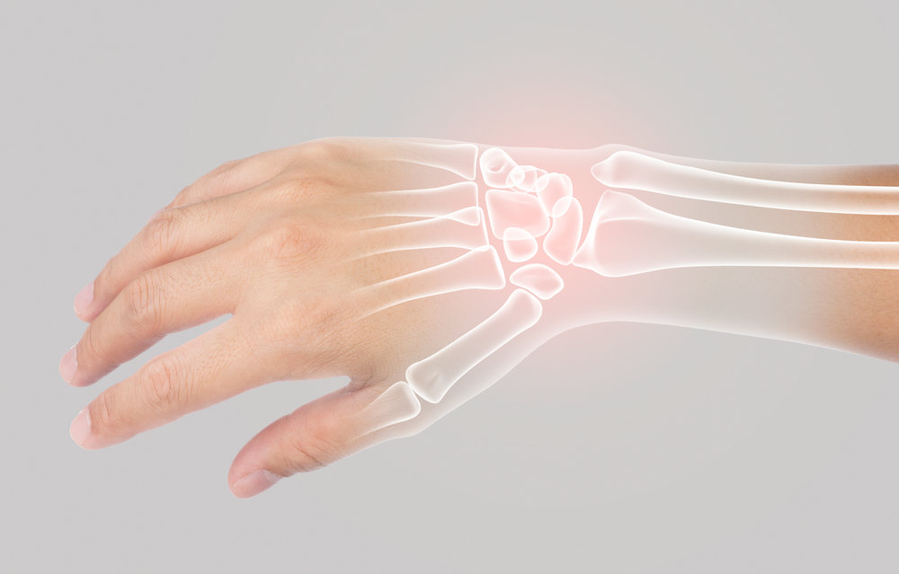 What is a scapholunate ligament injury?