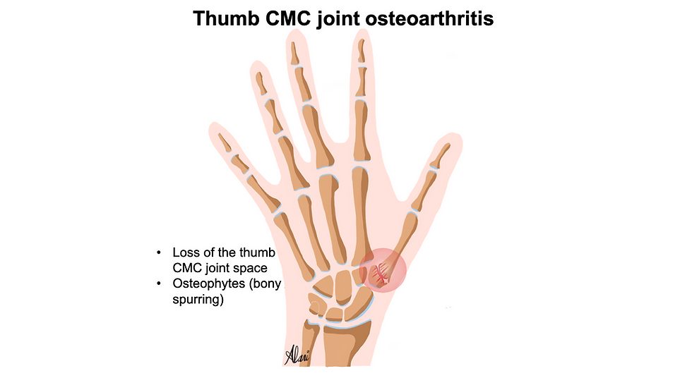 Thumb Osteoarthritis Cortisone Injection Musculoskeletal Ultrasound