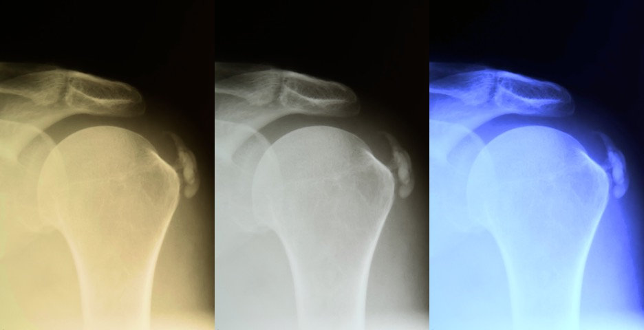 Ultrasound-Guided Shoulder Barbotage for Calcific Tendonitis