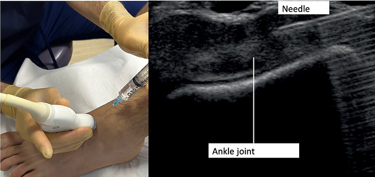 Ankle joint Cortisone injection | Musculoskeletal Ultrasound & Injections