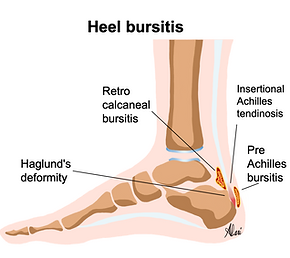 heel bursitis