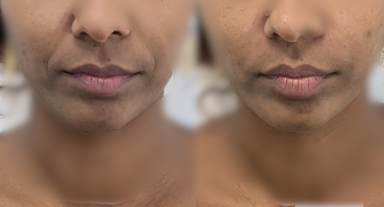 Zoom sur les sillons naso-géniens