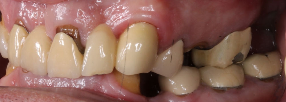 Full Mouth rehabilitation - Endo-Perio Prostho interferface.