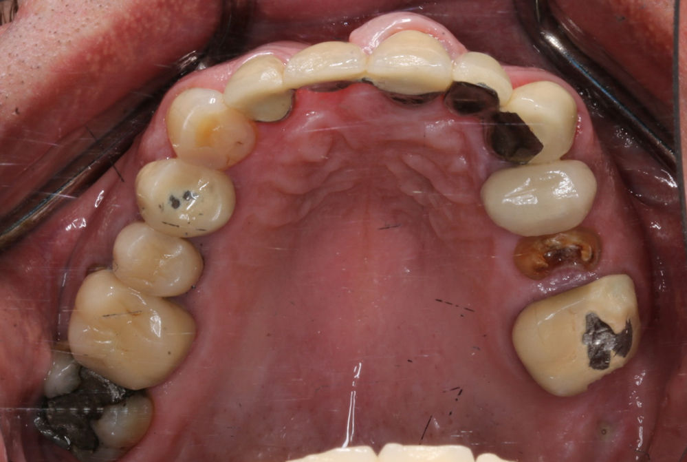Full Mouth rehabilitation - Endo-Perio Prostho interferface.