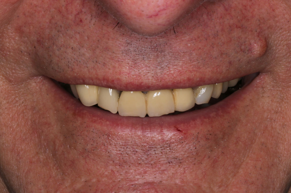 Full Mouth rehabilitation - Endo-Perio Prostho interferface.