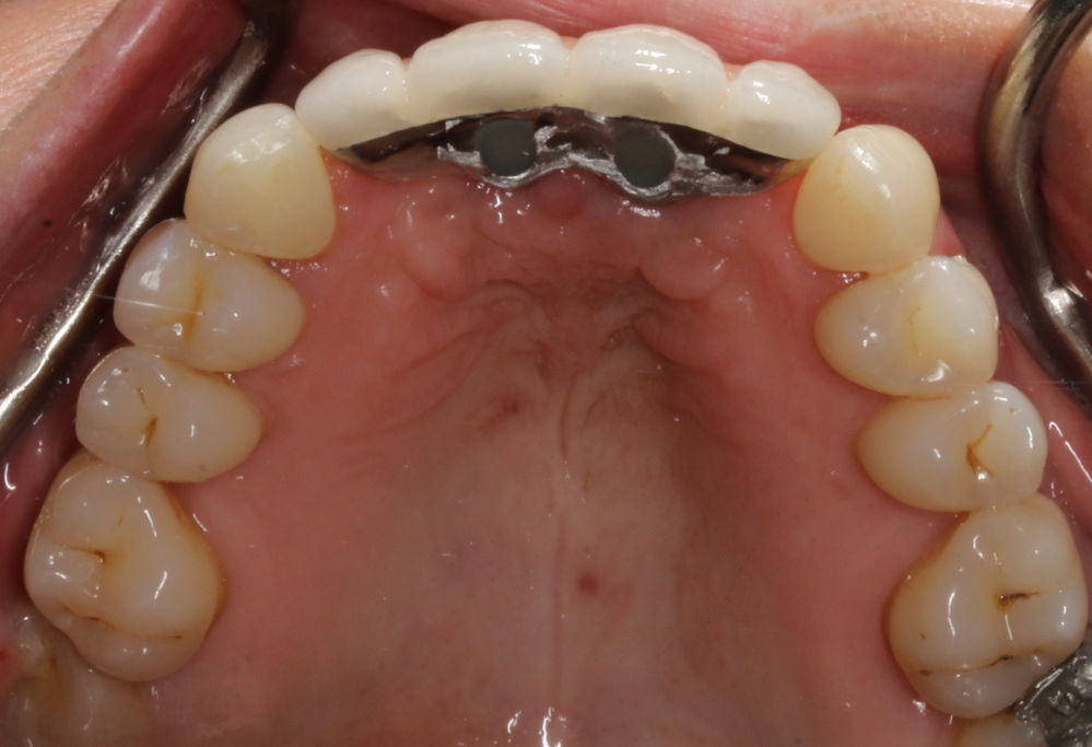 Implant bridges in the anterior