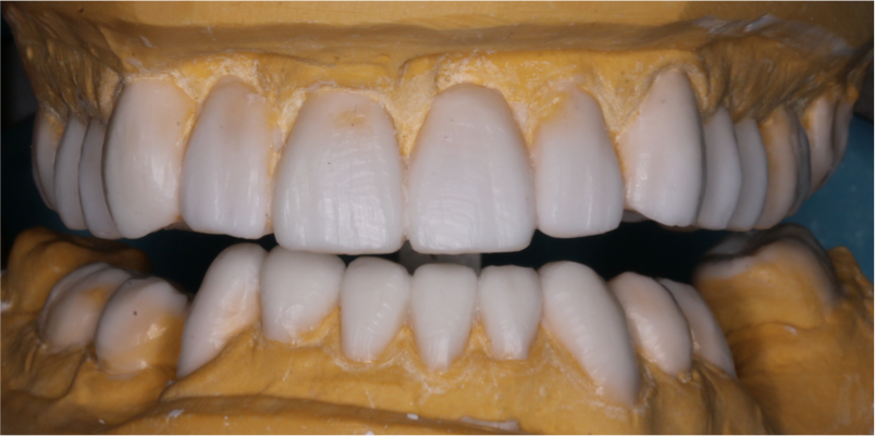 Full Mouth rehabilitation - Endo-Perio Prostho interferface.