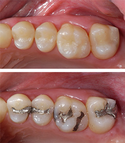 White or silver fillings - what's the difference and which is better ...