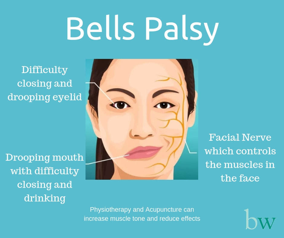 What is Bell’s Palsy and How Can You Speed Up Your Recovery? Bells Palsy