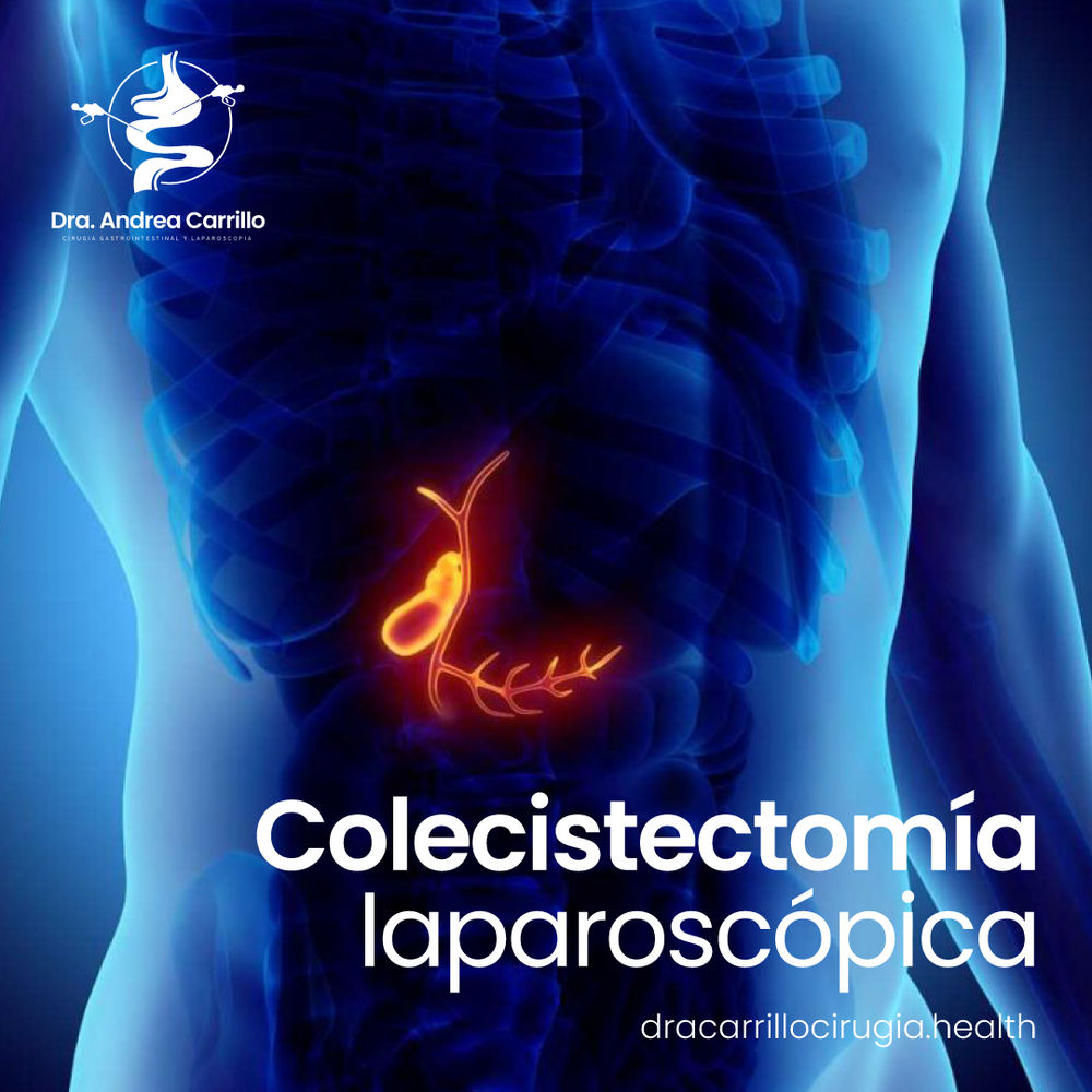 🪨 Colecistectomía laparoscópica. | Dra Andrea Carrillo