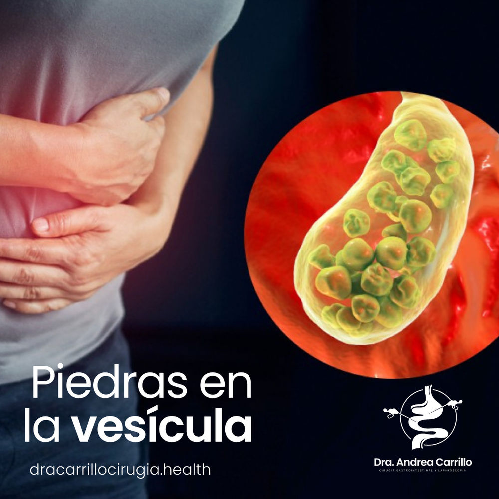 🪨 Cálculos en la vesícula. | Dra Andrea Carrillo