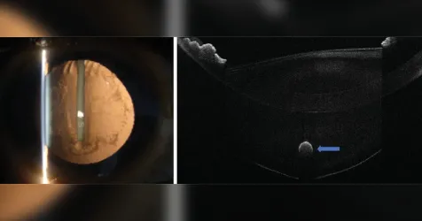 Ozurdex 0.7mg Injection | sandeepmed.com