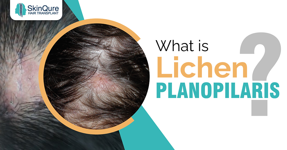 Lichen Planopilaris (LPP): Hair Loss, Symptoms & Treatment By Dr. Jangid