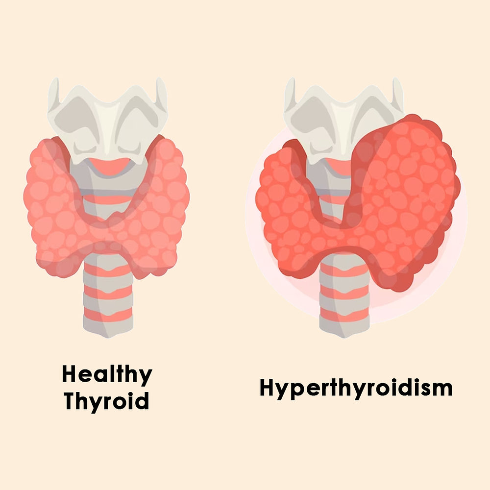 Hyperthyroidism - an overview | Vedic Med Global